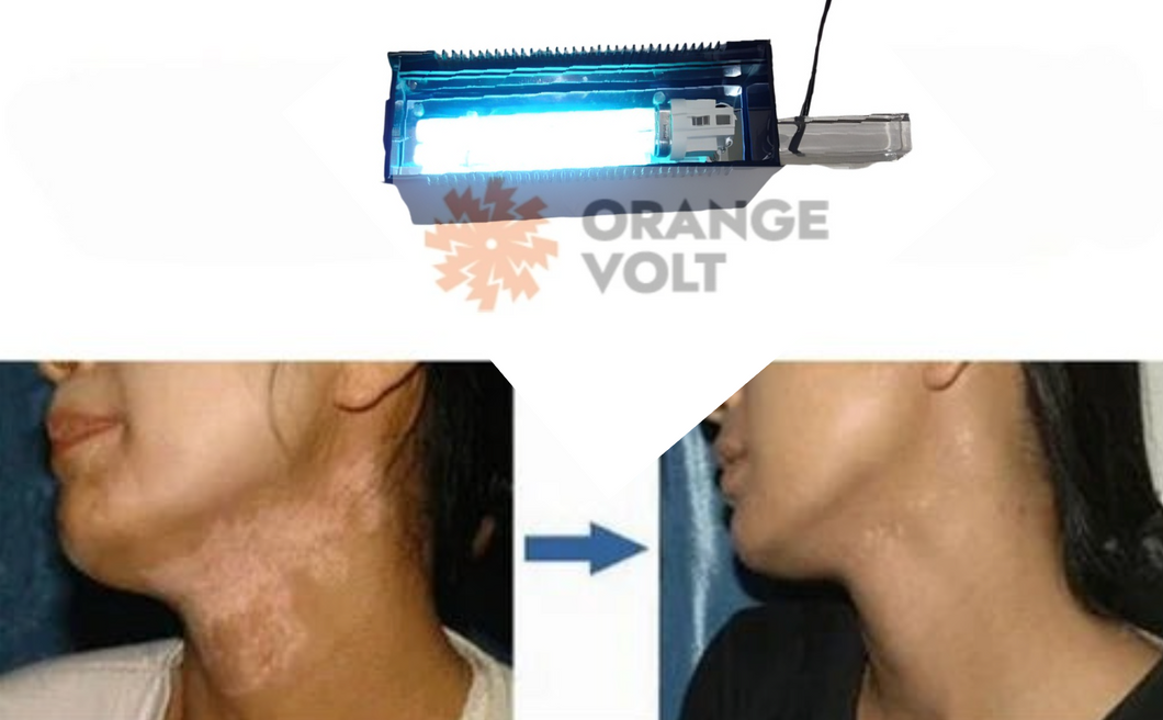 Philips Narrow-Band Ultraviolet-B (NB-UVB) Therapy for Vitiligo